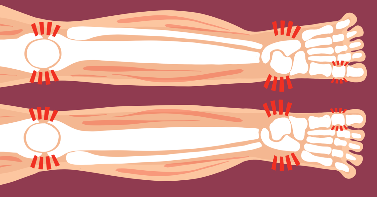 Arthritis and Restless Legs Syndrome: It's Not Just 'Getting Old'